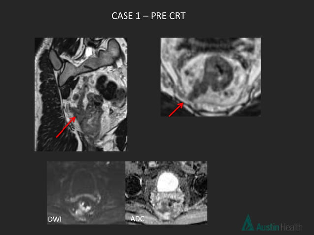 Rectal MRI .pptx