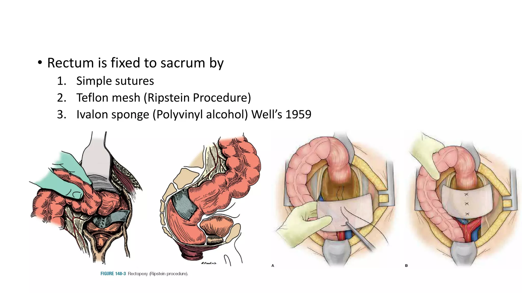 Rectal prolapse | PDF