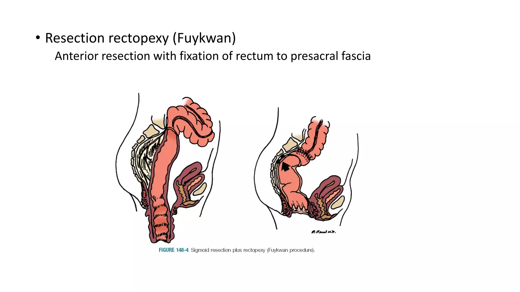 Rectal prolapse | PDF