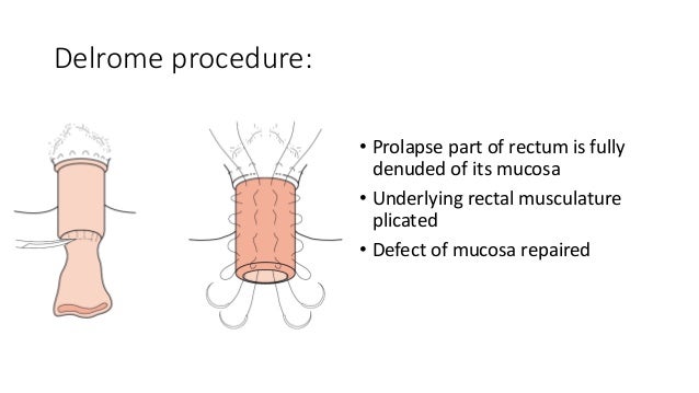Rectal prolapse
