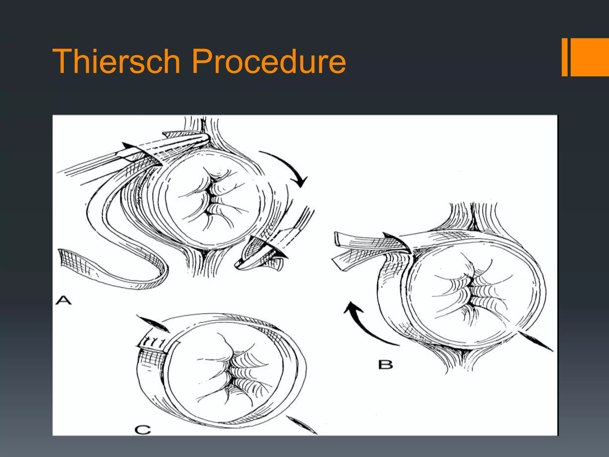 Rectal prolapse | PPTX