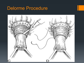 Rectal prolapse | PPTX