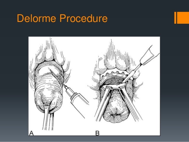 Chirurgie Des Rektumprolapses , Chirurgie des obstruktiven ...