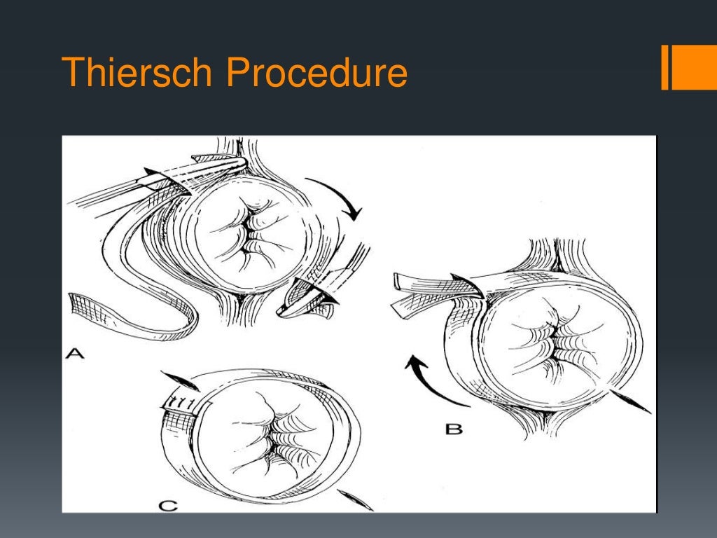 What Is Rectal Prolapse And How It Will Be Cured By Dr Vaginal Prolapse ...