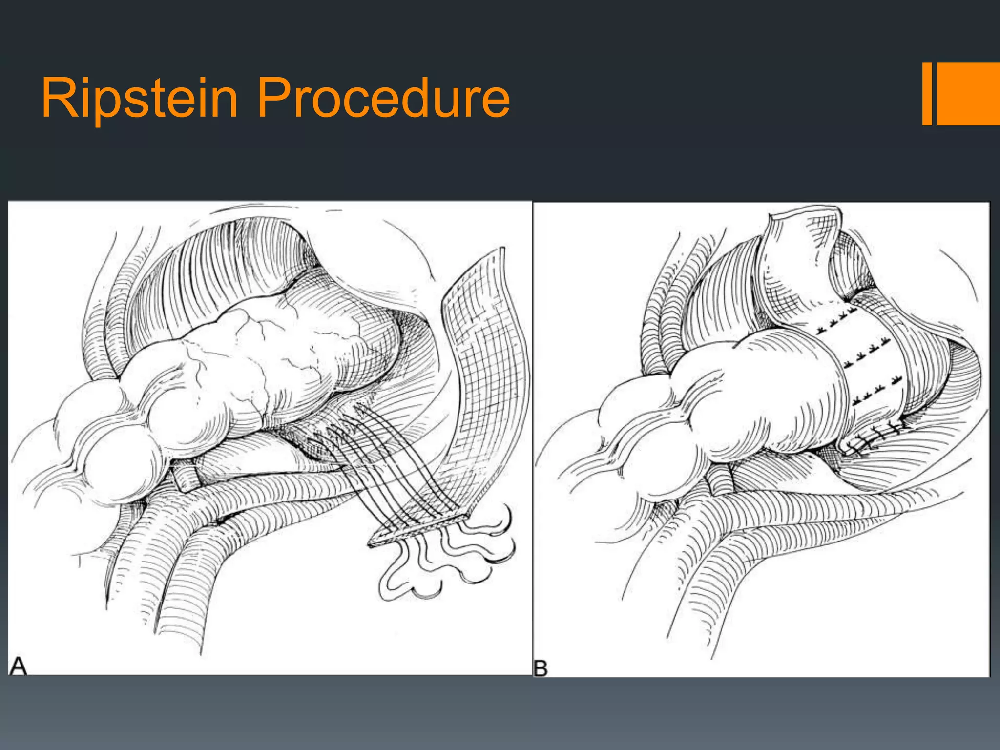 Rectal prolapse | PPTX
