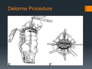 Rectal prolapse | PPTX