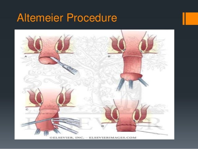 Altemeier Perineal Proctectomy – ILOC