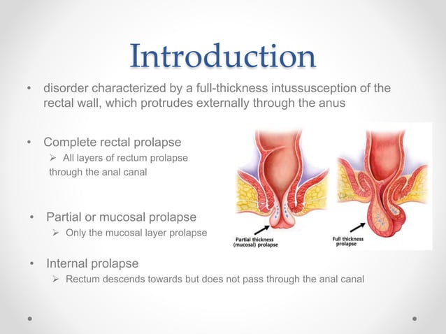 Rectal prolapse (D1) | PPTX | Digestive Disorders | Diseases and Conditions
