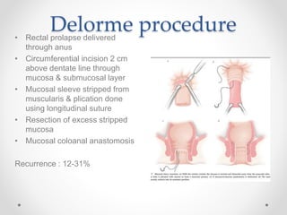 Rectal prolapse (D1) | PPTX