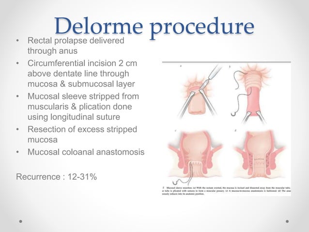 Rectal prolapse (D1) | PPTX | Digestive Disorders | Diseases and Conditions