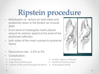 Rectal prolapse (D1) | PPT