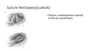 RECTAL PROLAPSE.pdf