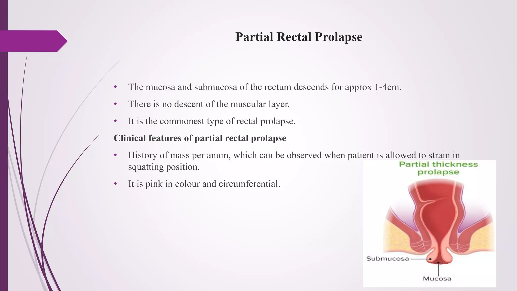 RECTAL prolapse.pptx