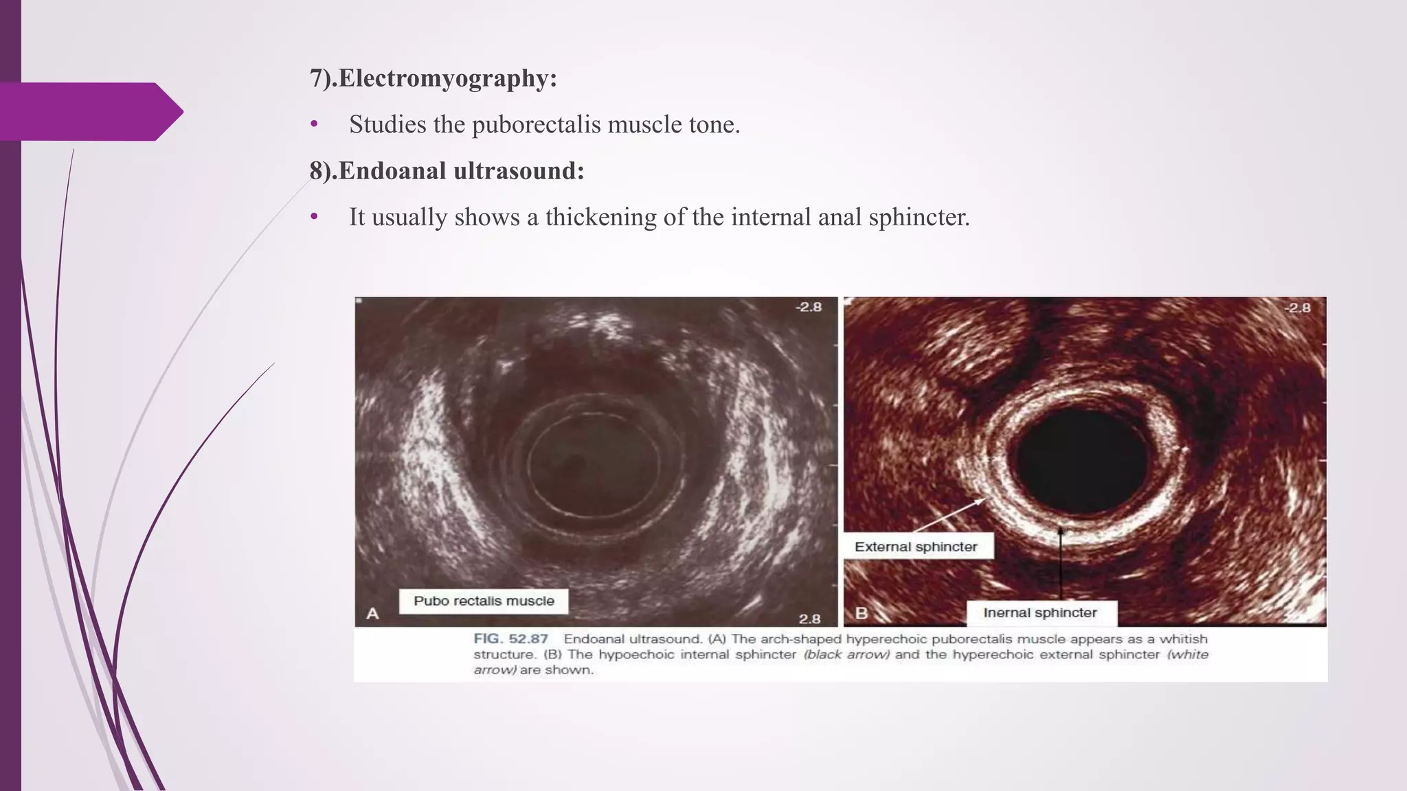 RECTAL prolapse.pptx