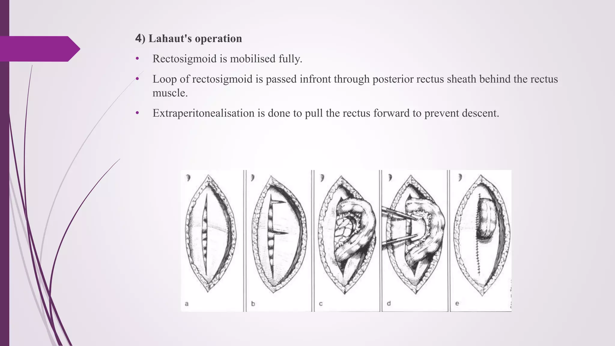 RECTAL prolapse.pptx