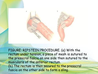 RECTAL_PROLAPSE.pdf