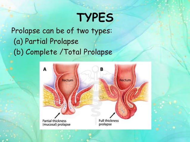 RECTAL_PROLAPSE.pdf