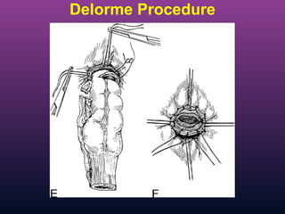 Rectal Prolapse - Cedars Sinai Medical Center - Medicine Resident Talk ...