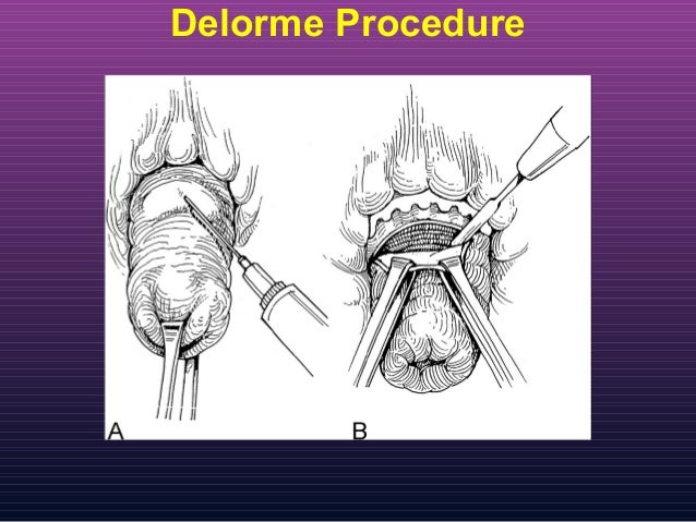 Rectal Prolapse - Cedars Sinai Medical Center - Medicine Resident Talk