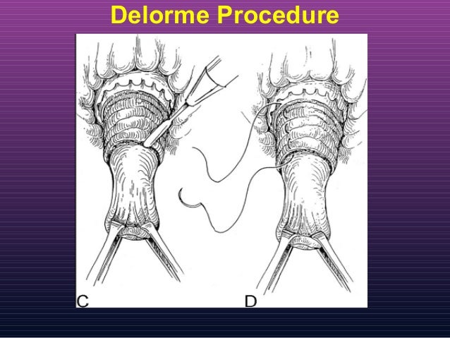 Rectal Prolapse - Cedars Sinai Medical Center - Medicine Resident Talk