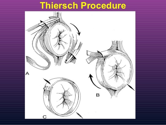 Rectal Prolapse - Cedars Sinai Medical Center - Medicine Resident Talk