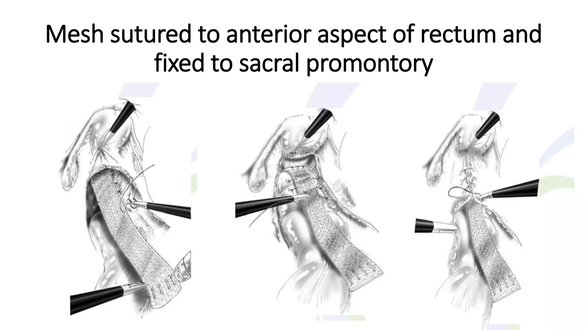 Rectal prolapse: Do we really have a perfect surgical solution? pptx ...