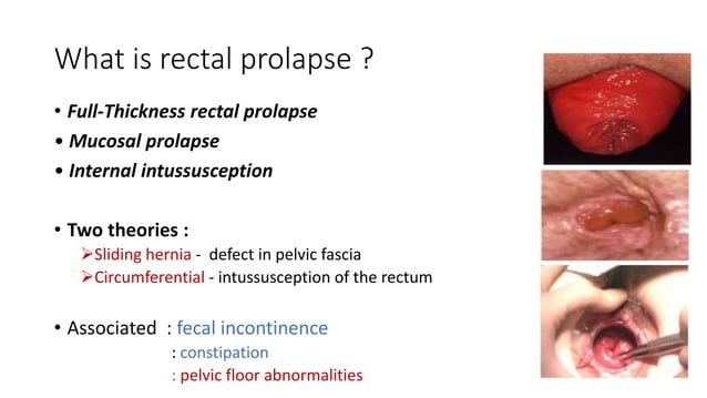Rectal prolapse: Do we really have a perfect surgical solution? pptx copy | PPTX