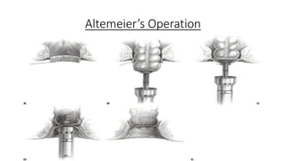 Rectal prolapse pathophysiology and management | PPTX