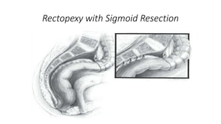 Rectal prolapse pathophysiology and management | PPTX
