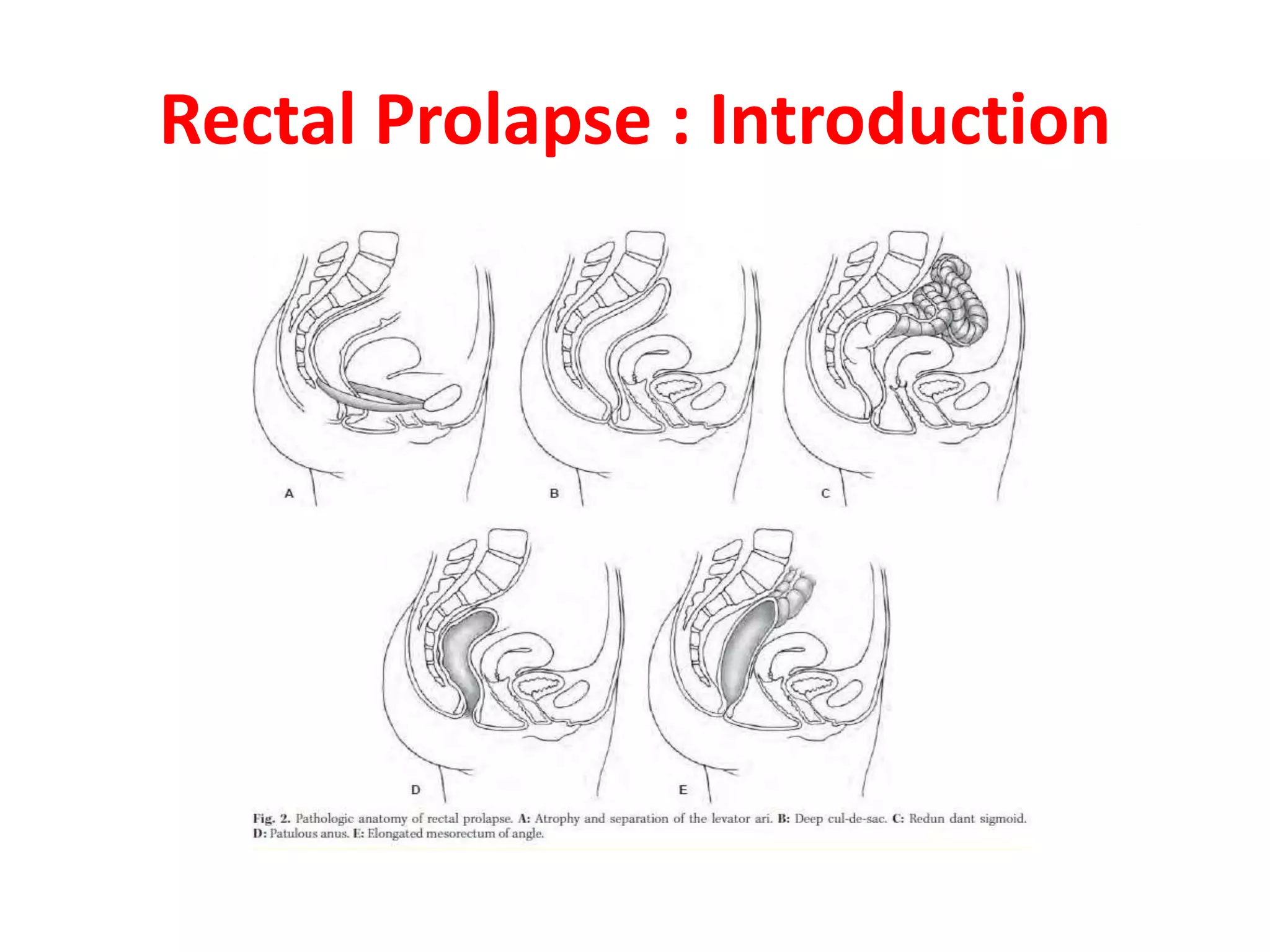 Rectal prolapse surgical approaches | PPTX