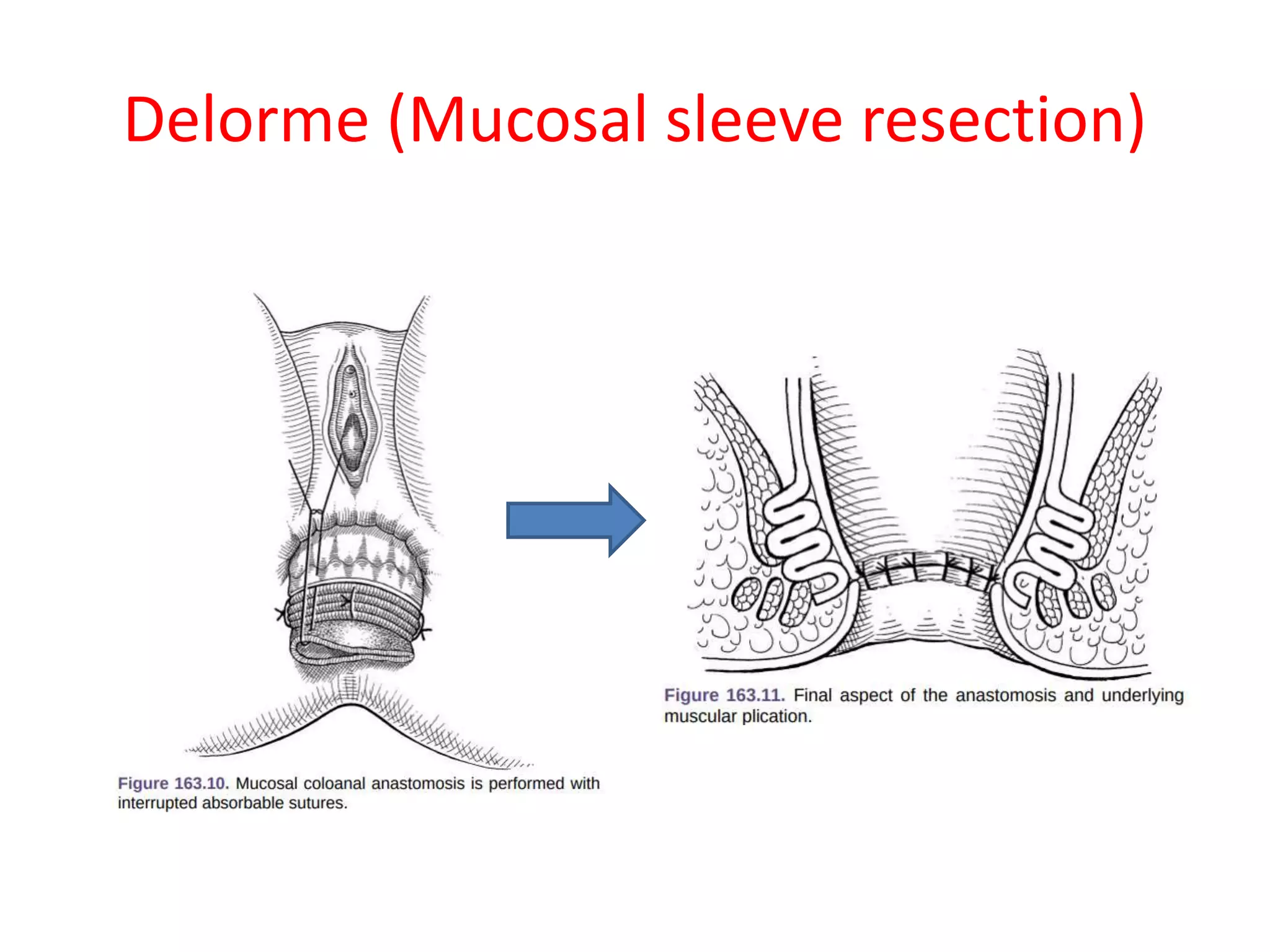 Rectal prolapse surgical approaches | PPTX