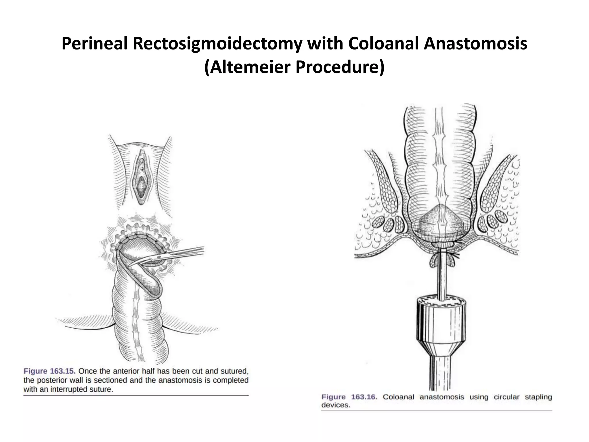 Rectal prolapse surgical approaches | PPTX