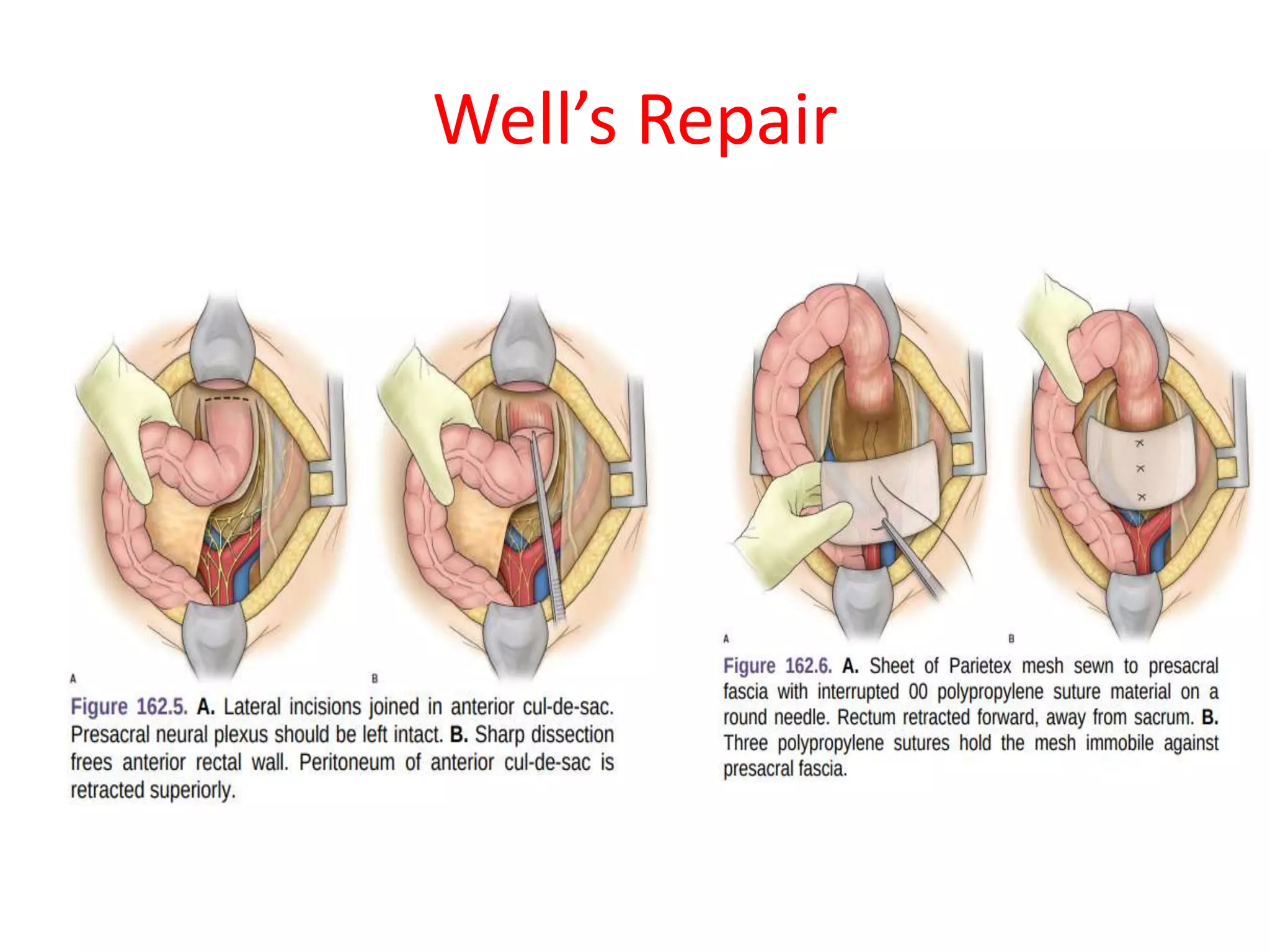 Rectal Prolapse Surgical Approaches Pptx