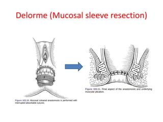 Rectal prolapse surgical approaches | PPTX