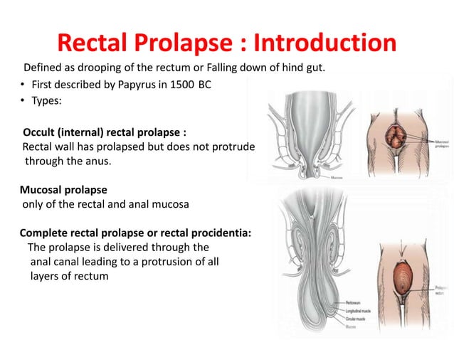 Rectal prolapse surgical approaches | PPTX