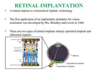 Artificial Retina | PPT