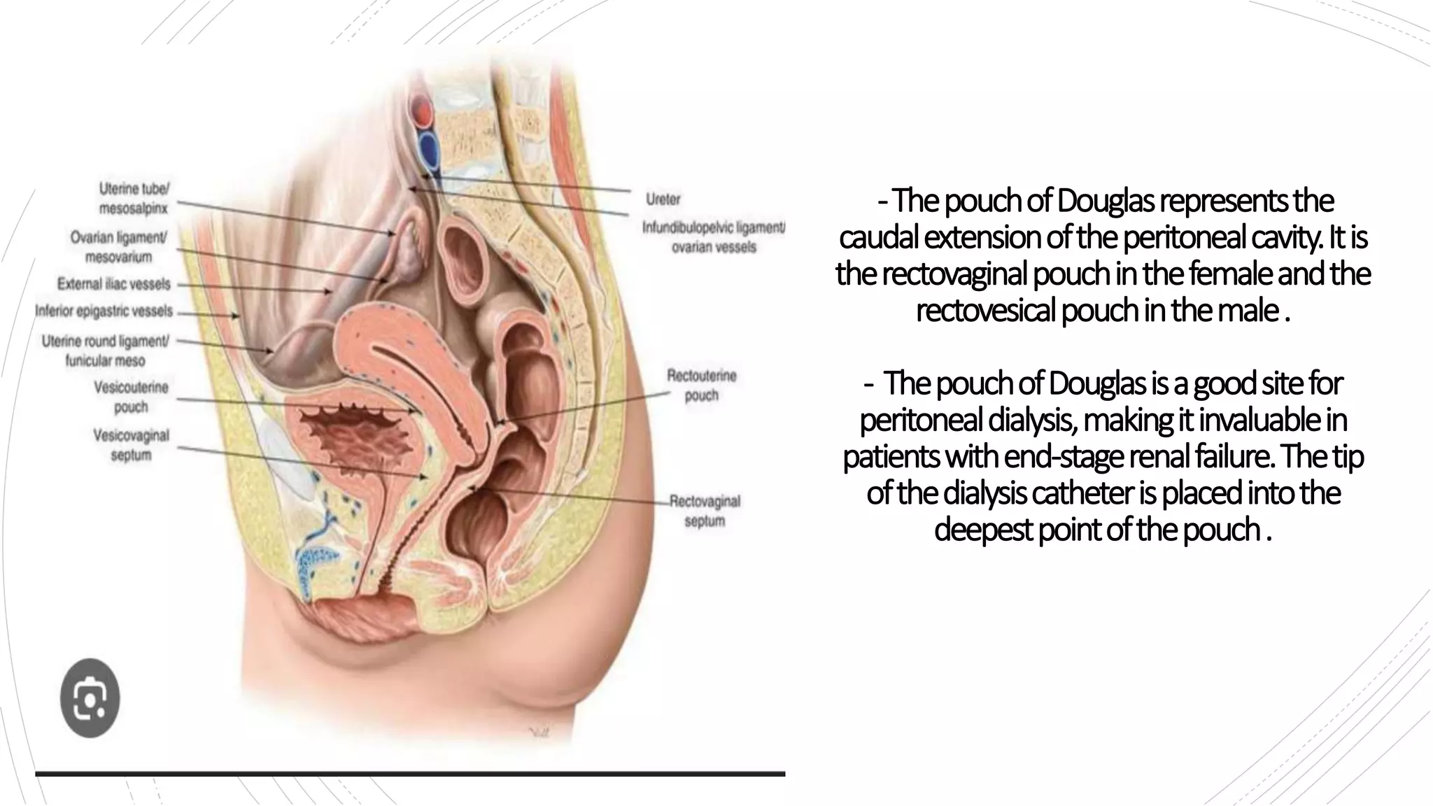 Rectouterine Pouch.pptx