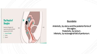 Rectouterine Pouch.pptx