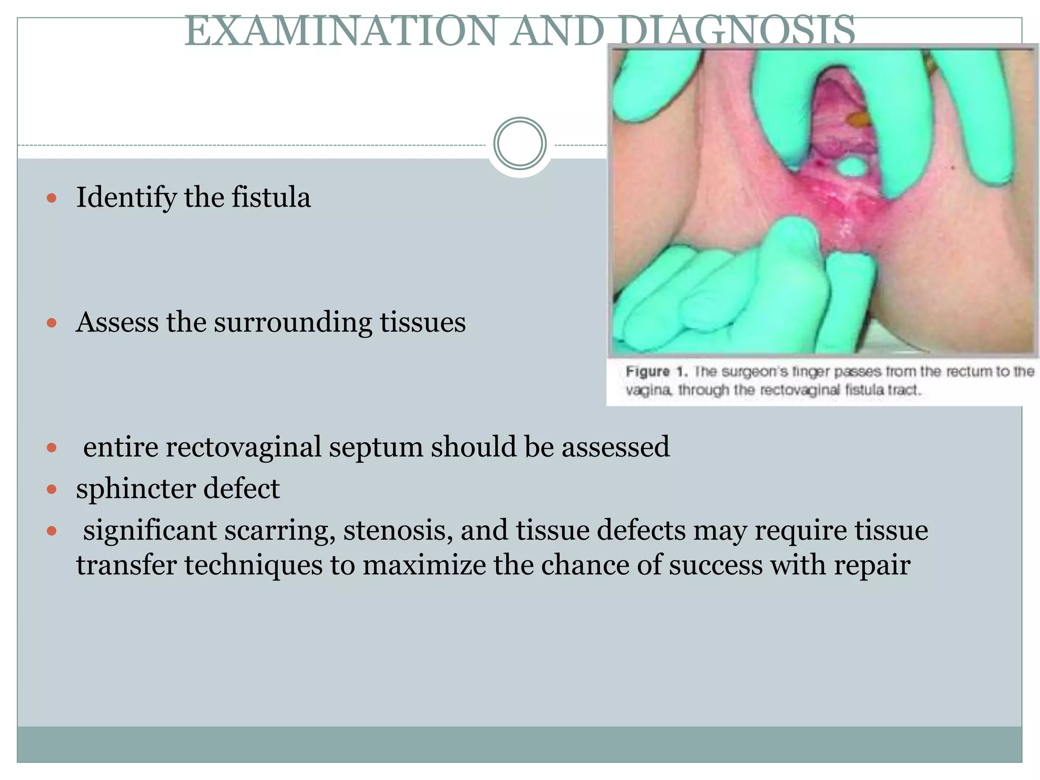 Rectovaginal and rectourethral fistulas | PPTX