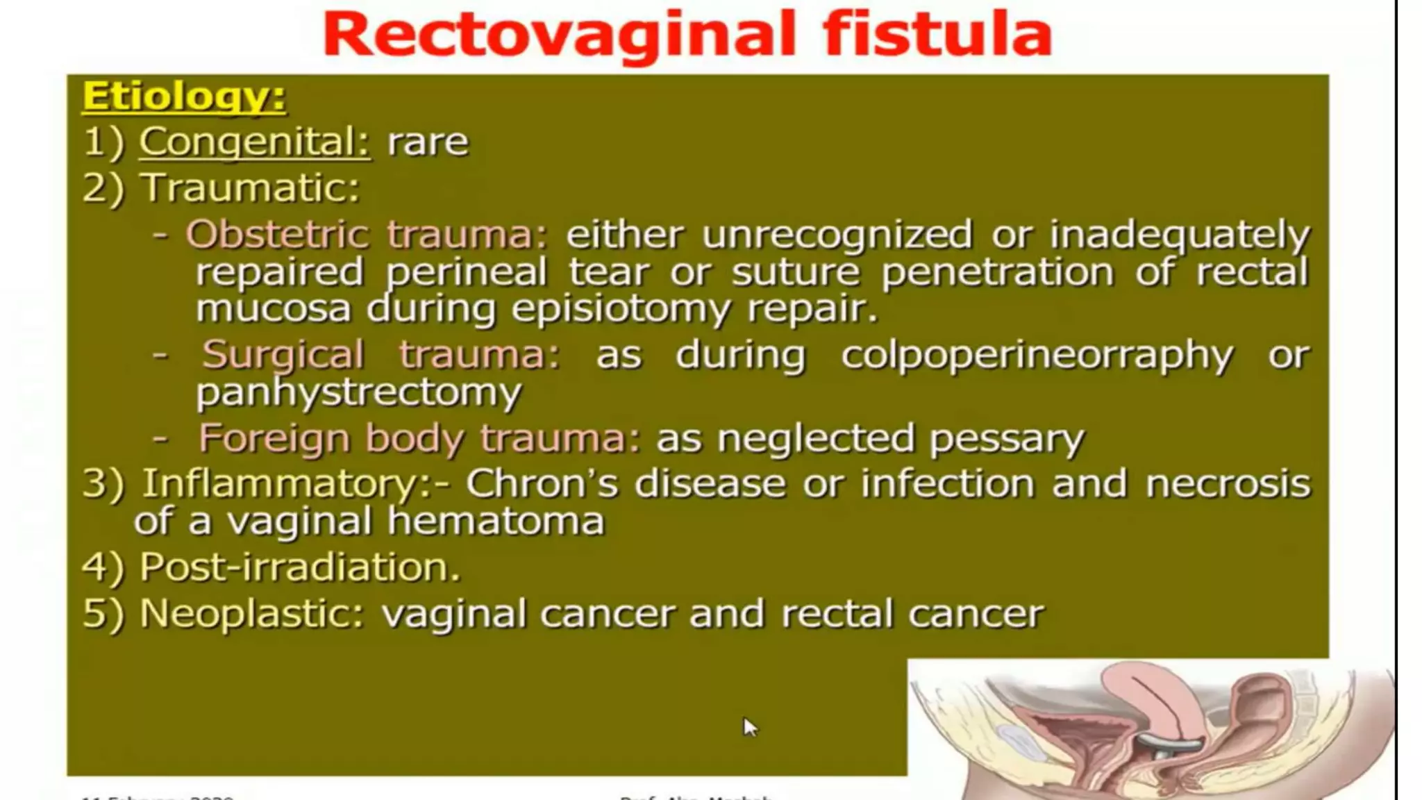 Rectovaginal fistula by Dr Manoj chellani | PPTX
