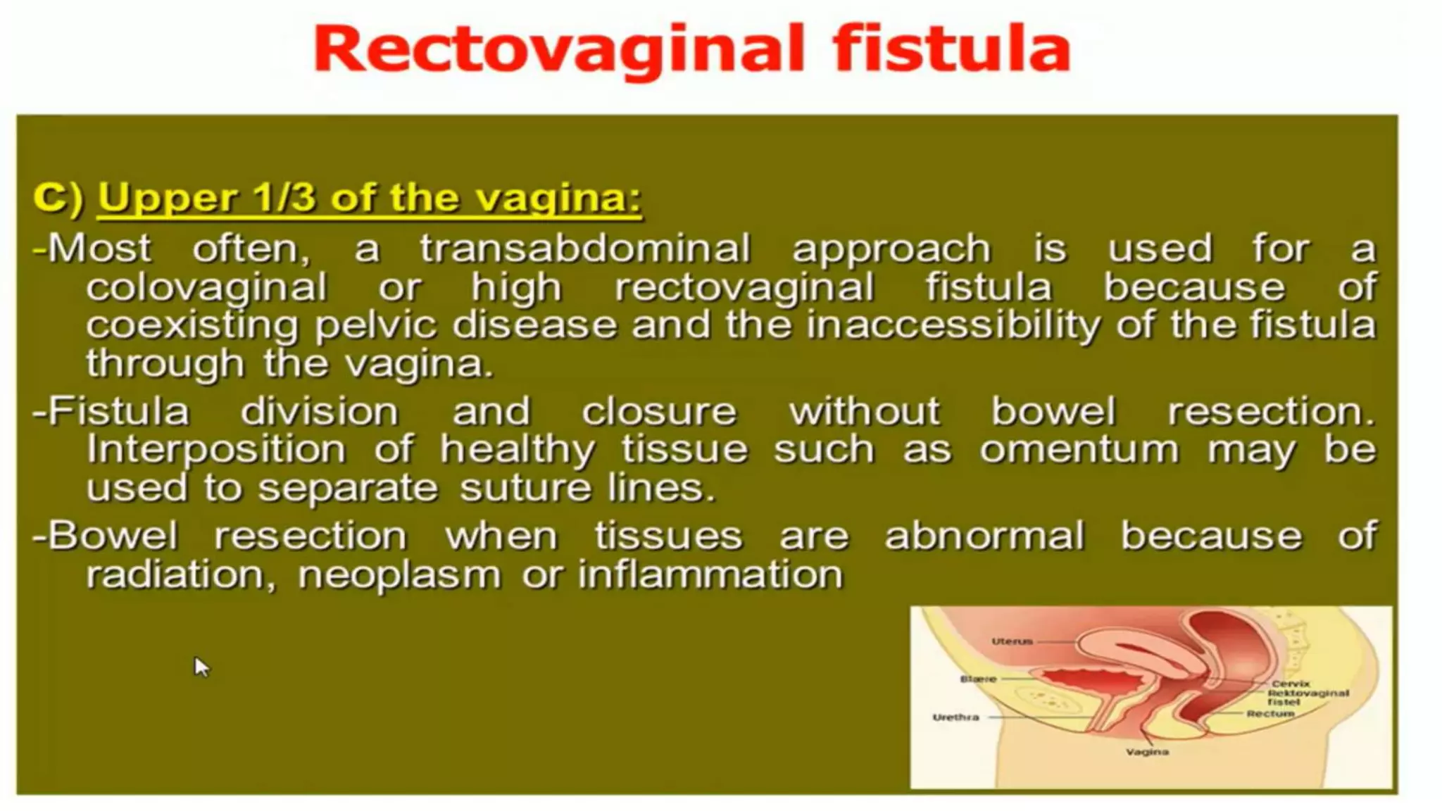 Rectovaginal fistula by Dr Manoj chellani | PPTX
