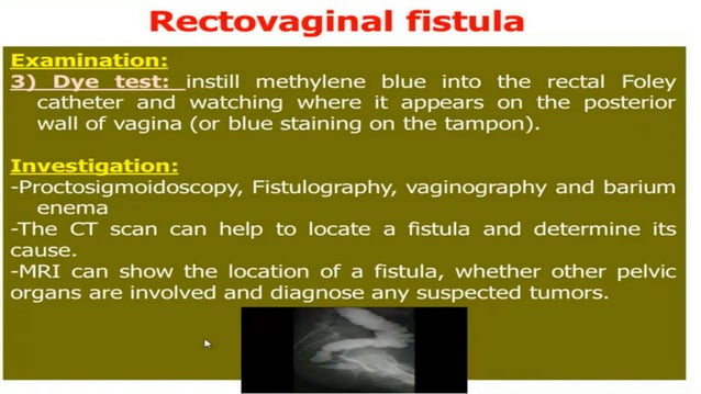 Rectovaginal fistula by Dr Manoj chellani | PPTX