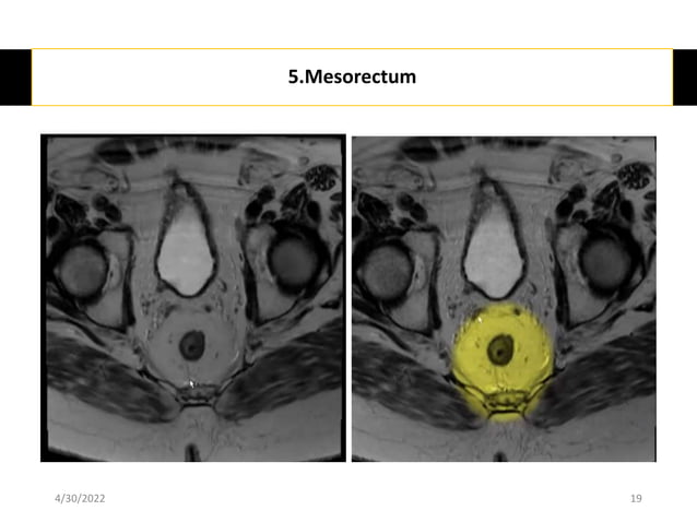RADIOLOGY OF CANCER RECTUM | PPT