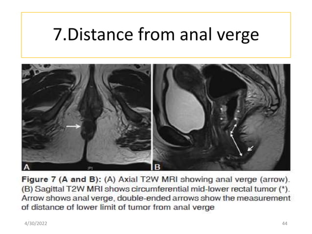 RADIOLOGY OF CANCER RECTUM | PPT