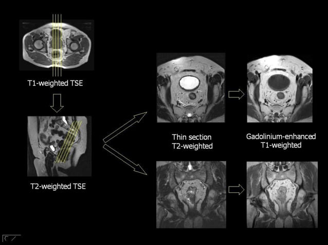 RADIOLOGY OF CANCER RECTUM | PPT