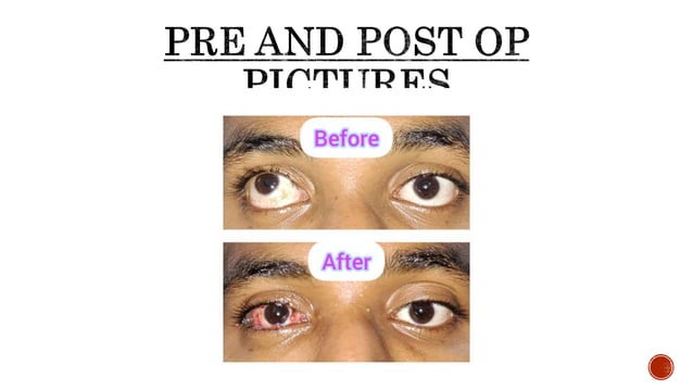 Rectus muscle plication for strabismus surgery final .pptx