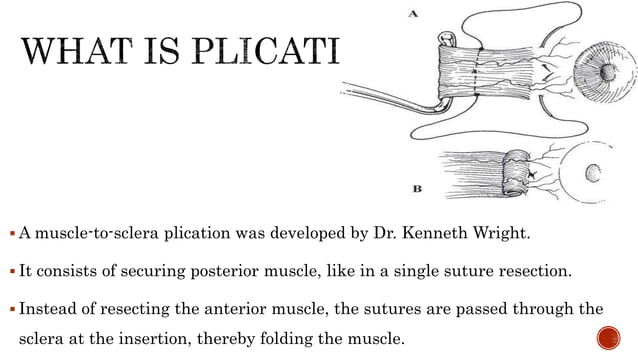 Rectus muscle plication for strabismus surgery final .pptx