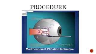 Rectus muscle plication for strabismus surgery final .pptx