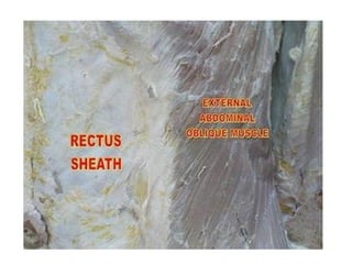 Rectus sheath | PPT