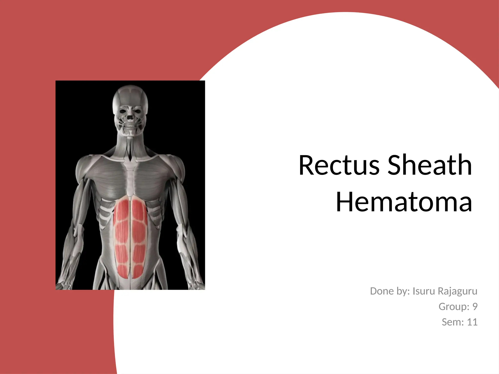 rectus sheath hematoma. surgical aspect | PPTX